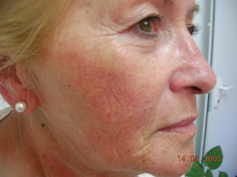 Vascular (Facial) Treatment – Active Optical Systems