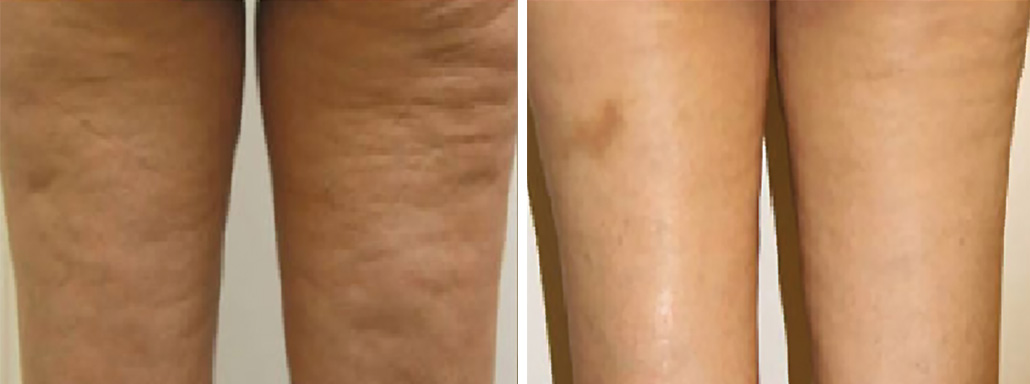 RF Cellulite Improvement – Active Optical Systems